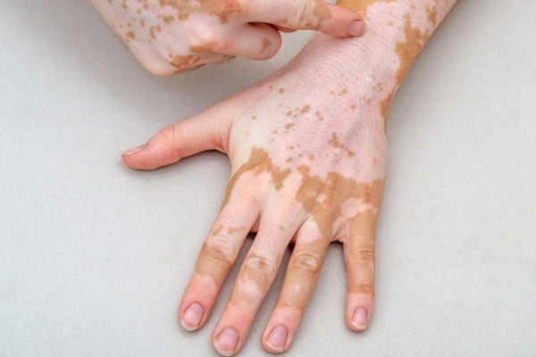 Penyebab Vitiligo, Bercak-bercak Putih di Tubuh dan Cara Pencegahannya